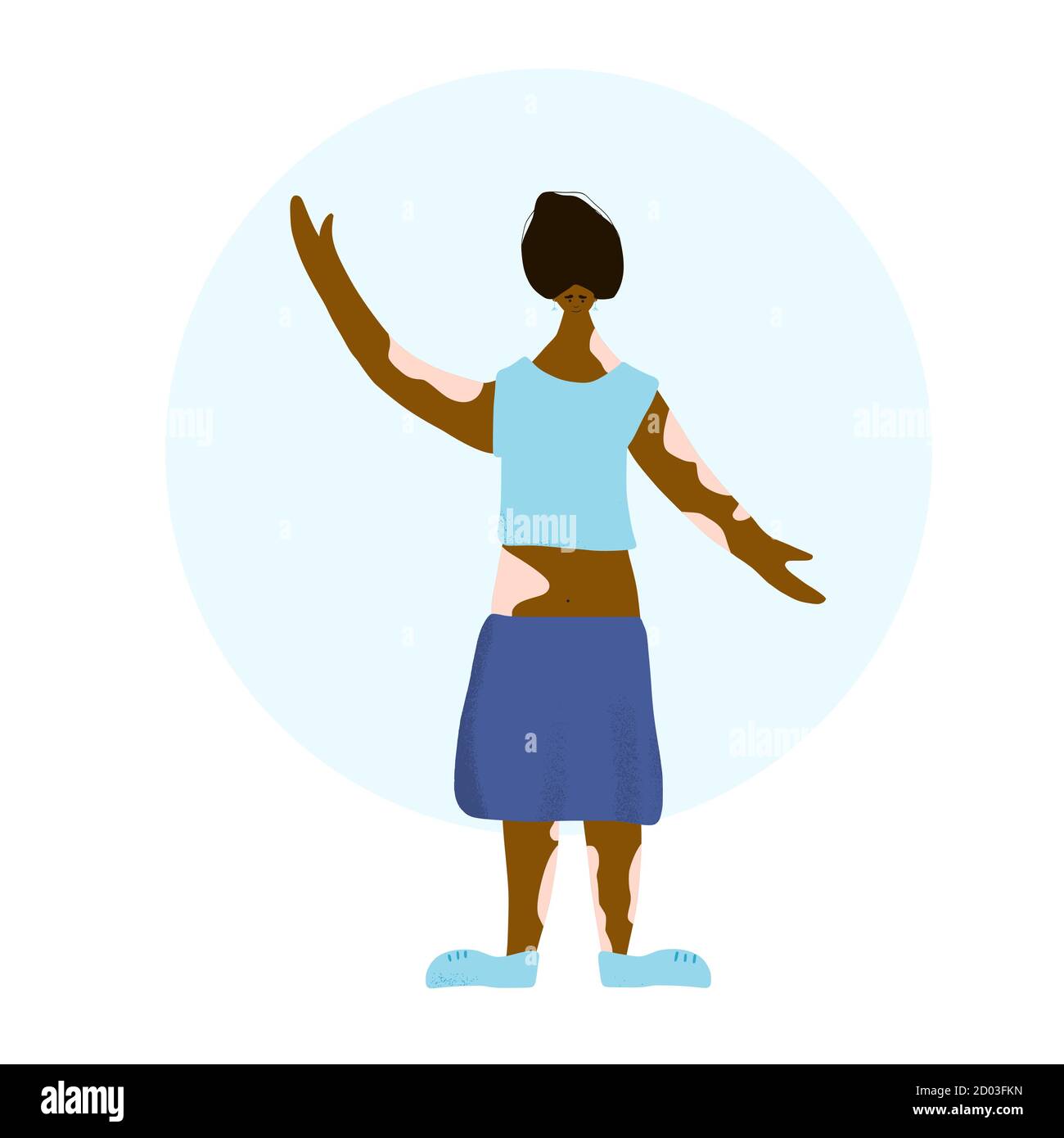 Vitiligo. Young beautiful woman with skin pigmentation. Vector ...