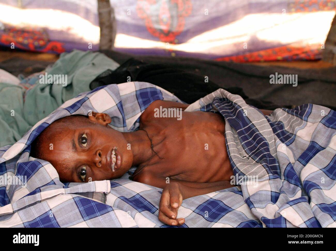Severely Malnourished High Resolution Stock Photography and Images - Alamy