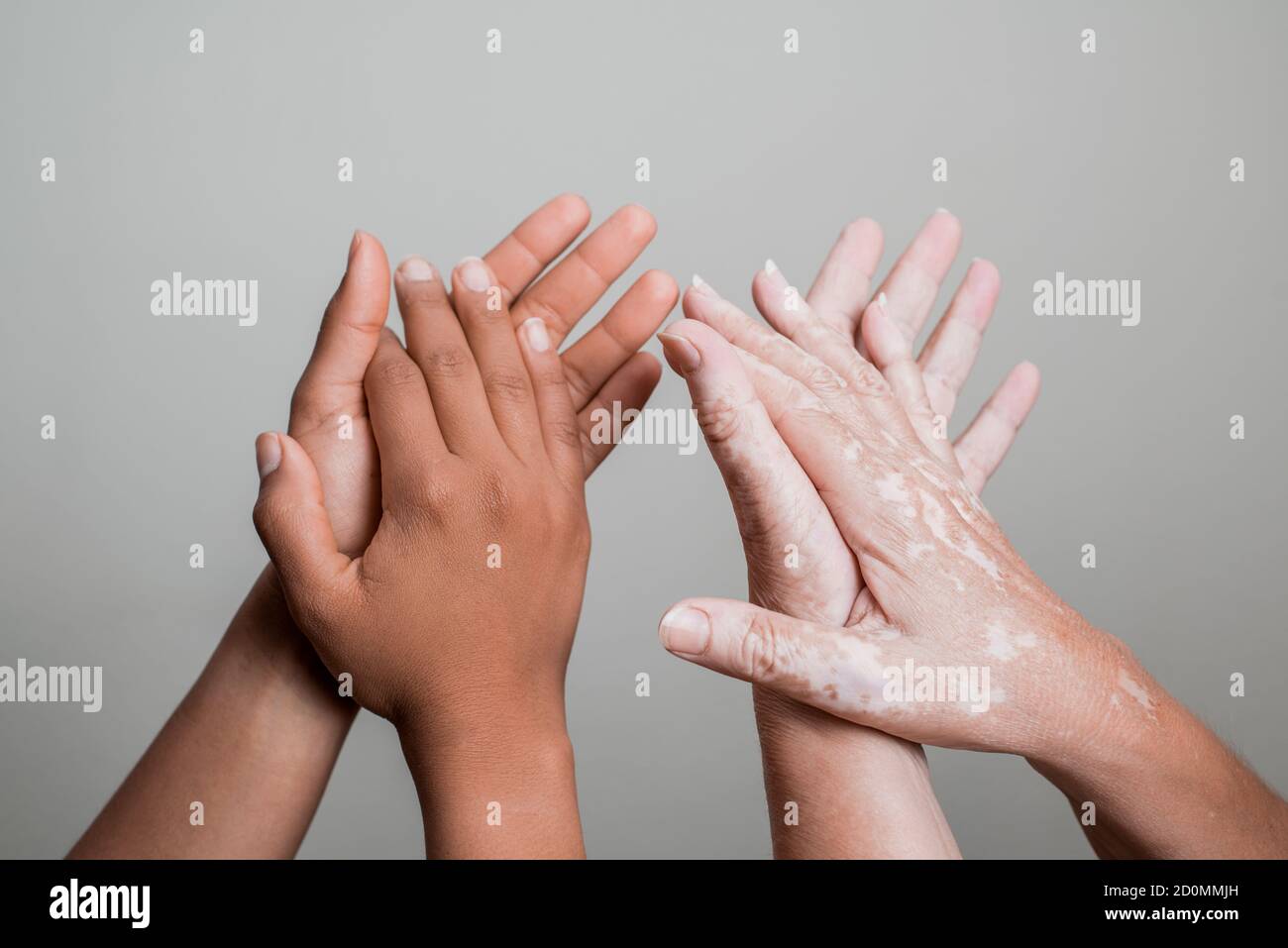 Black hand and senior hand with vitiligo clapping Stock Photo - Alamy