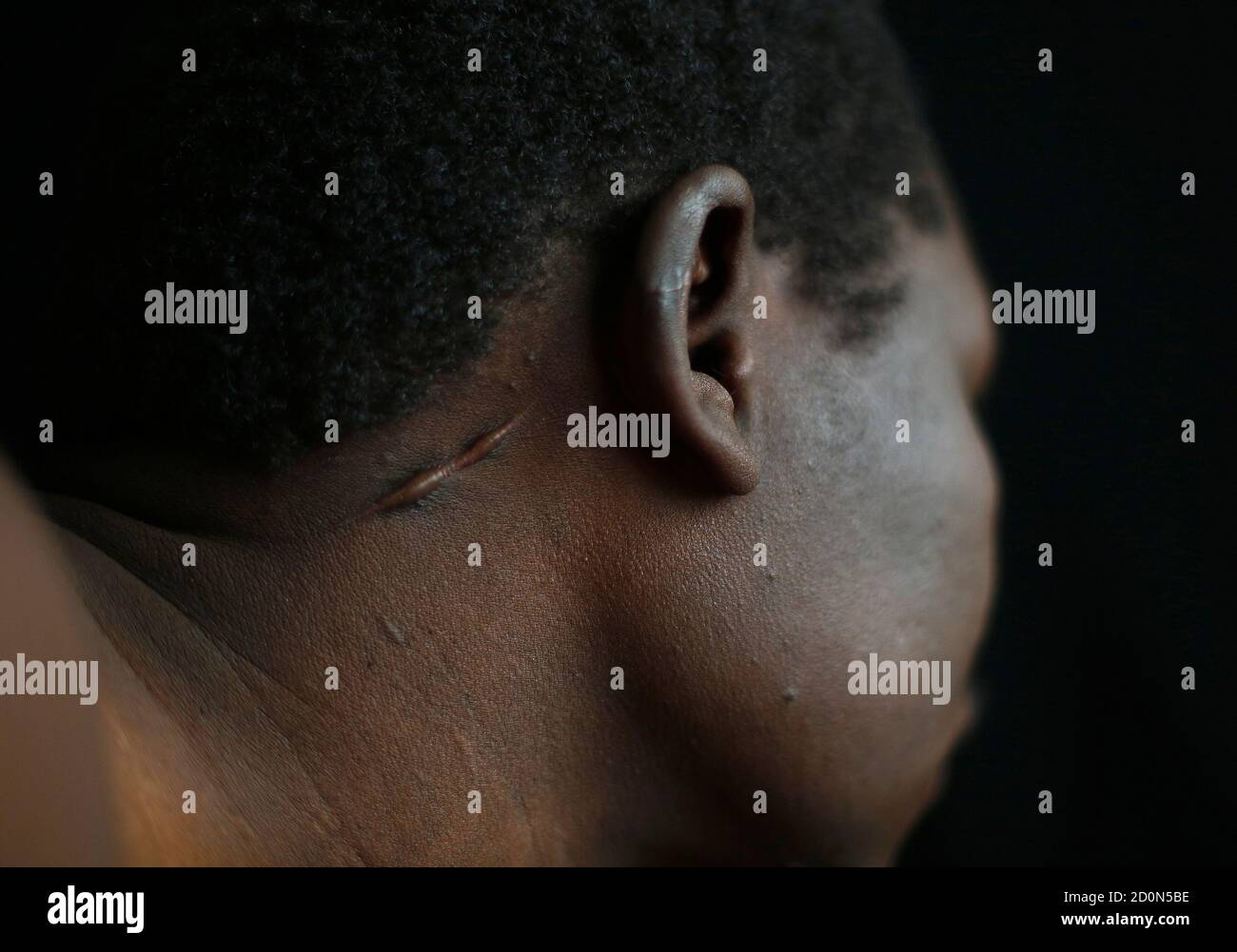 Scar in neck hi-res stock photography and images - Alamy