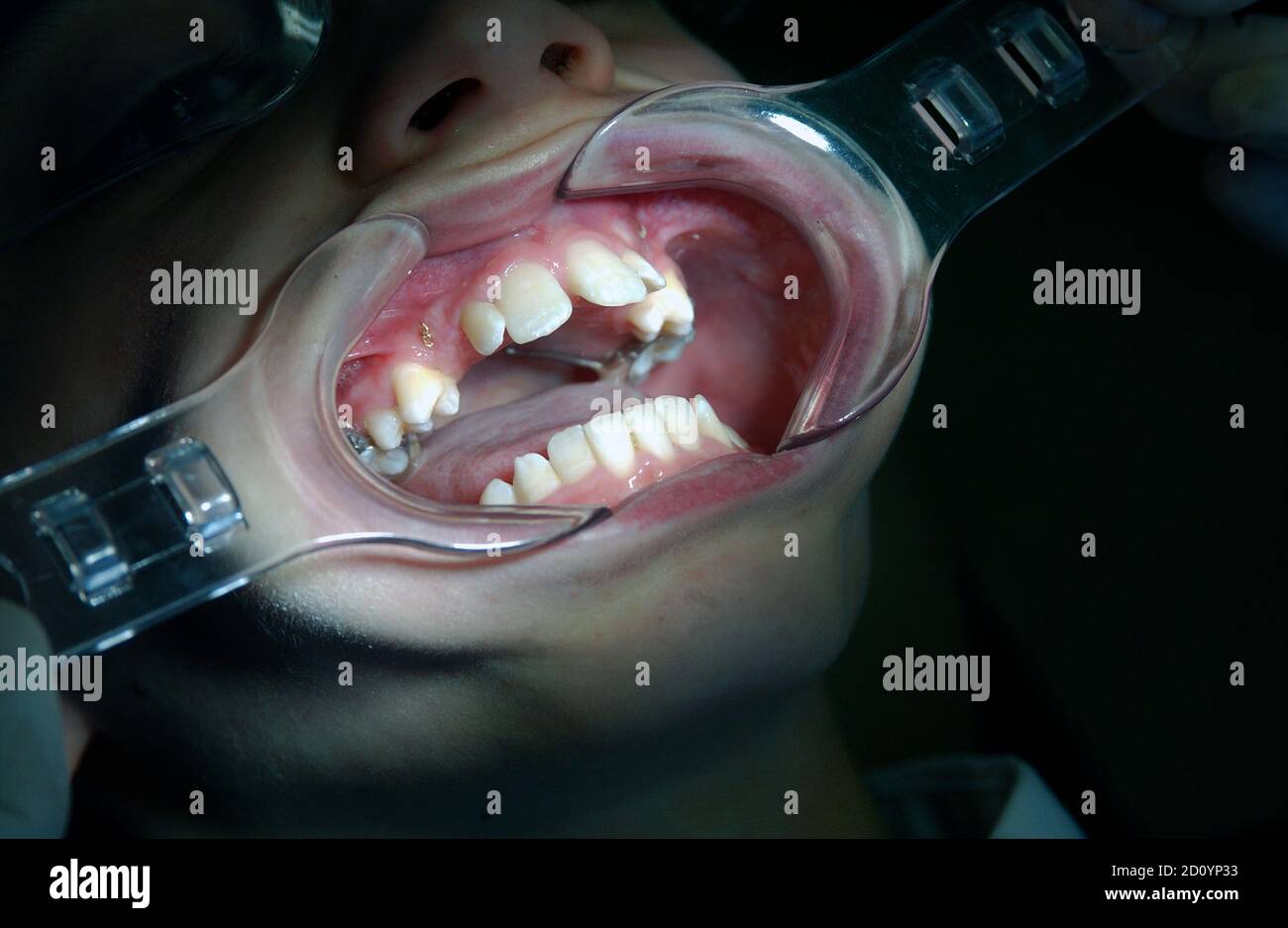Orthodontic procedure on the teeth of a young man Stock Photo - Alamy