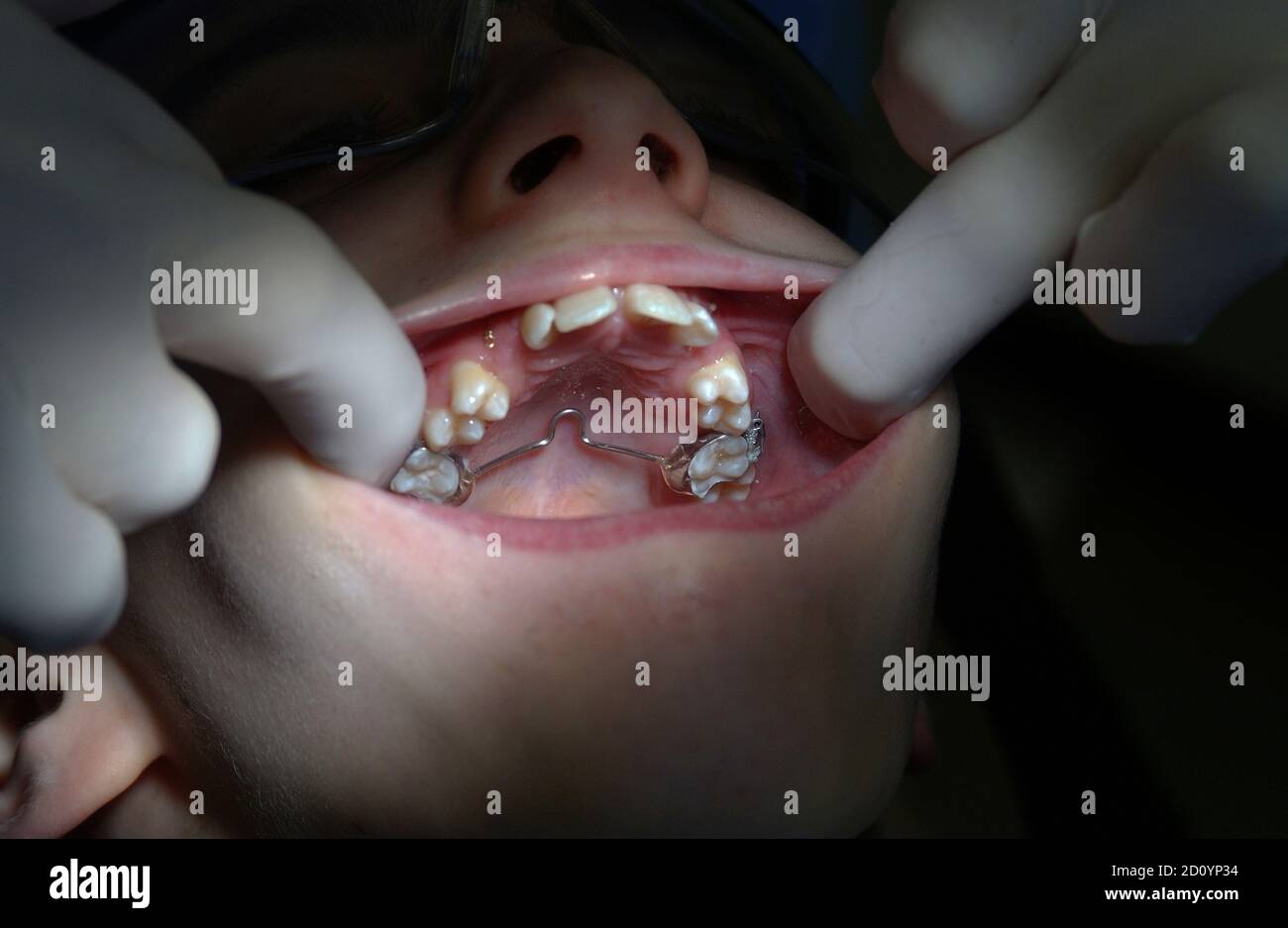 Orthodontic procedure on the teeth of a young man Stock Photo - Alamy