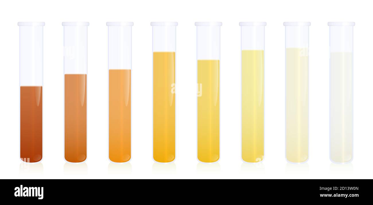 Urine samples, specimen test tubes with different colored urine ...