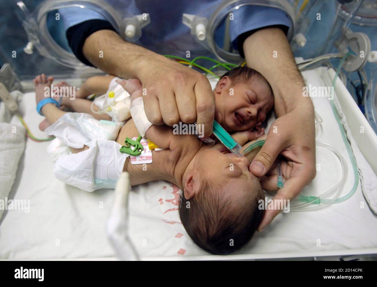 Conjoined twins born hi-res stock photography and images - Alamy