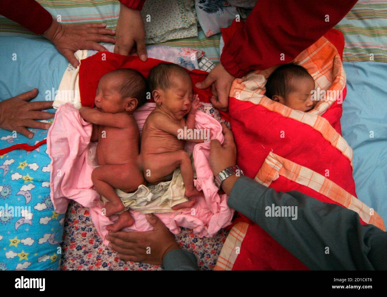 Unique Case Of Conjoined Triplets