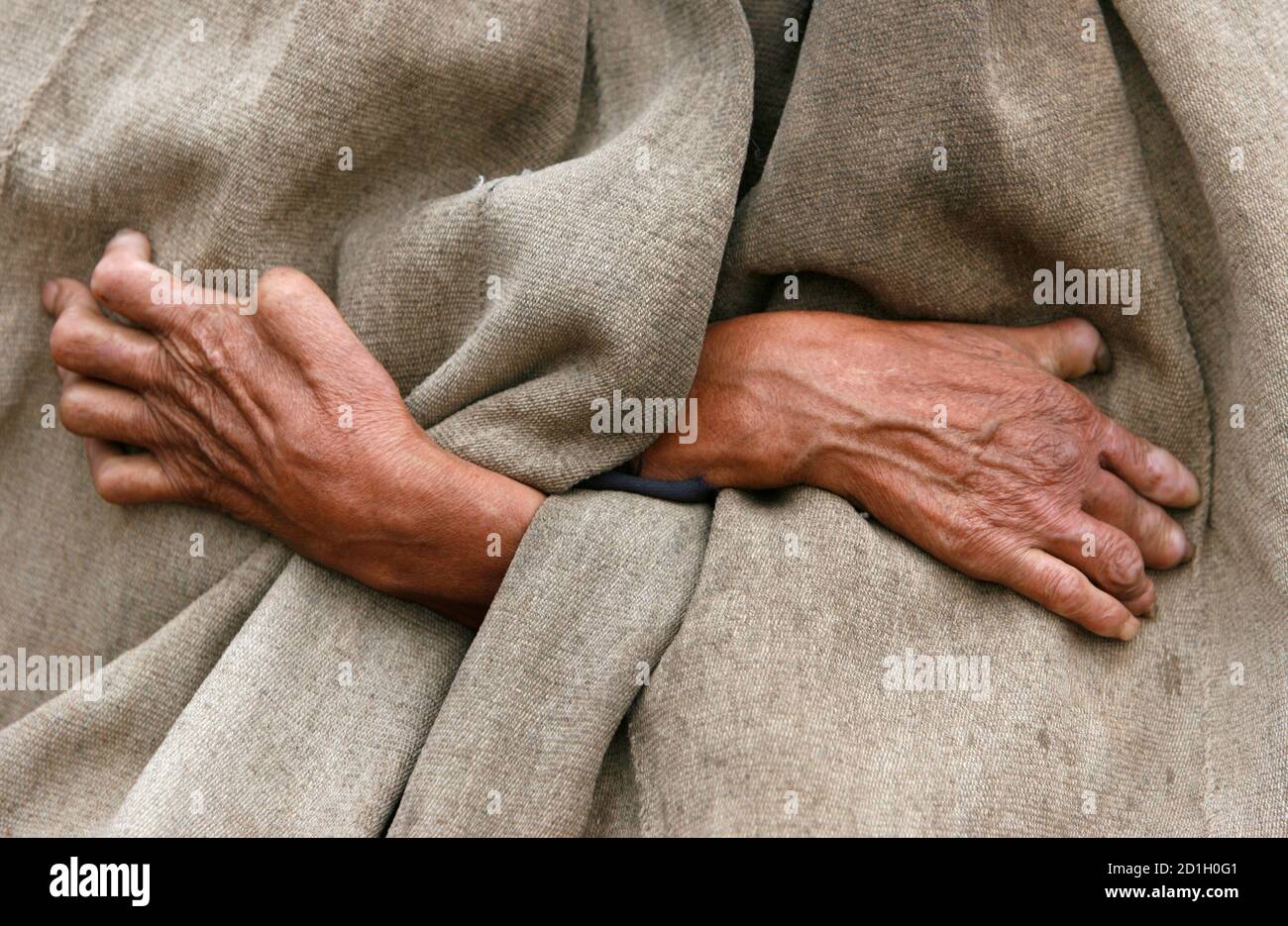 Leper hand hi-res stock photography and images - Alamy