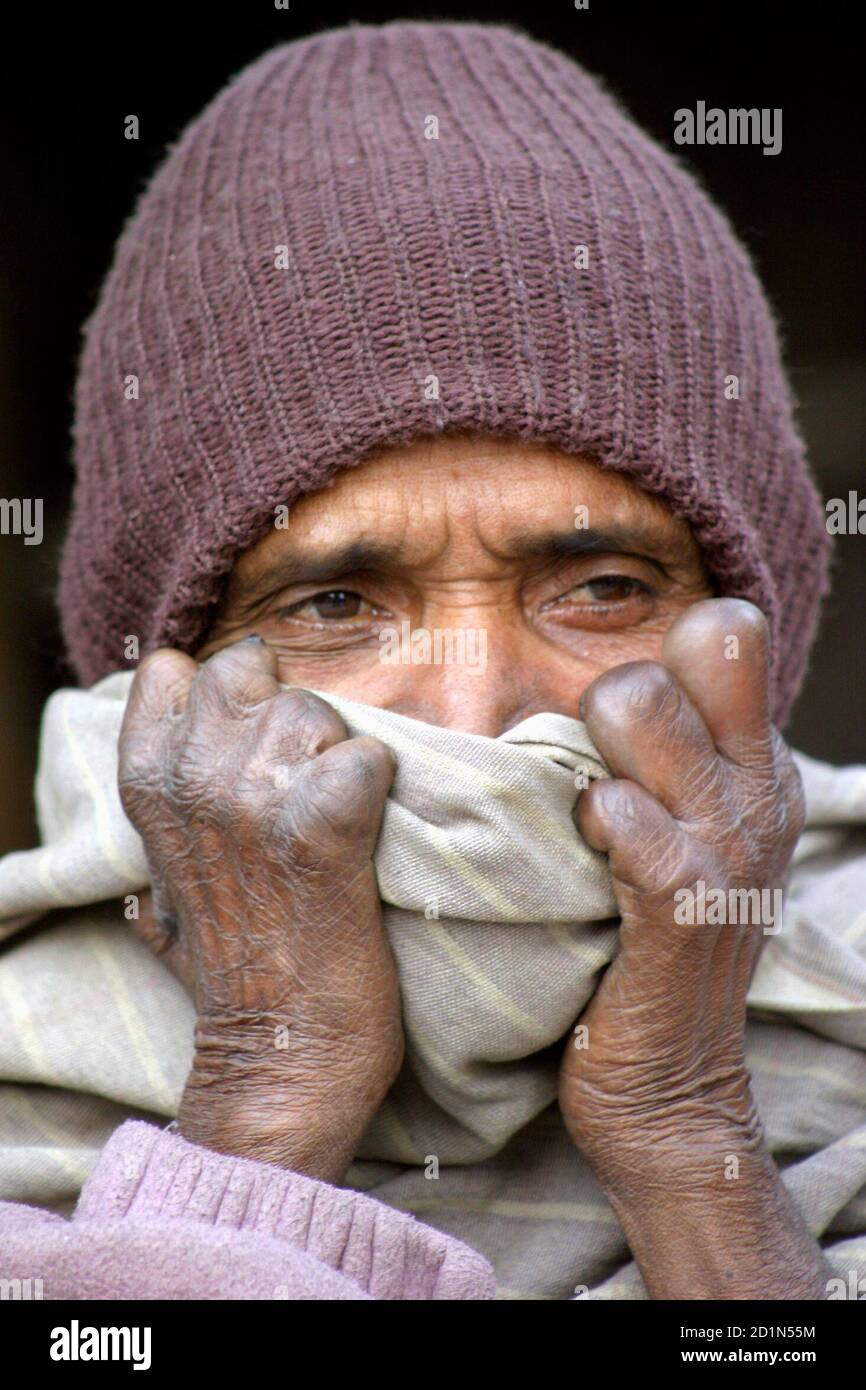 Leprosy in human hi-res stock photography and images - Alamy