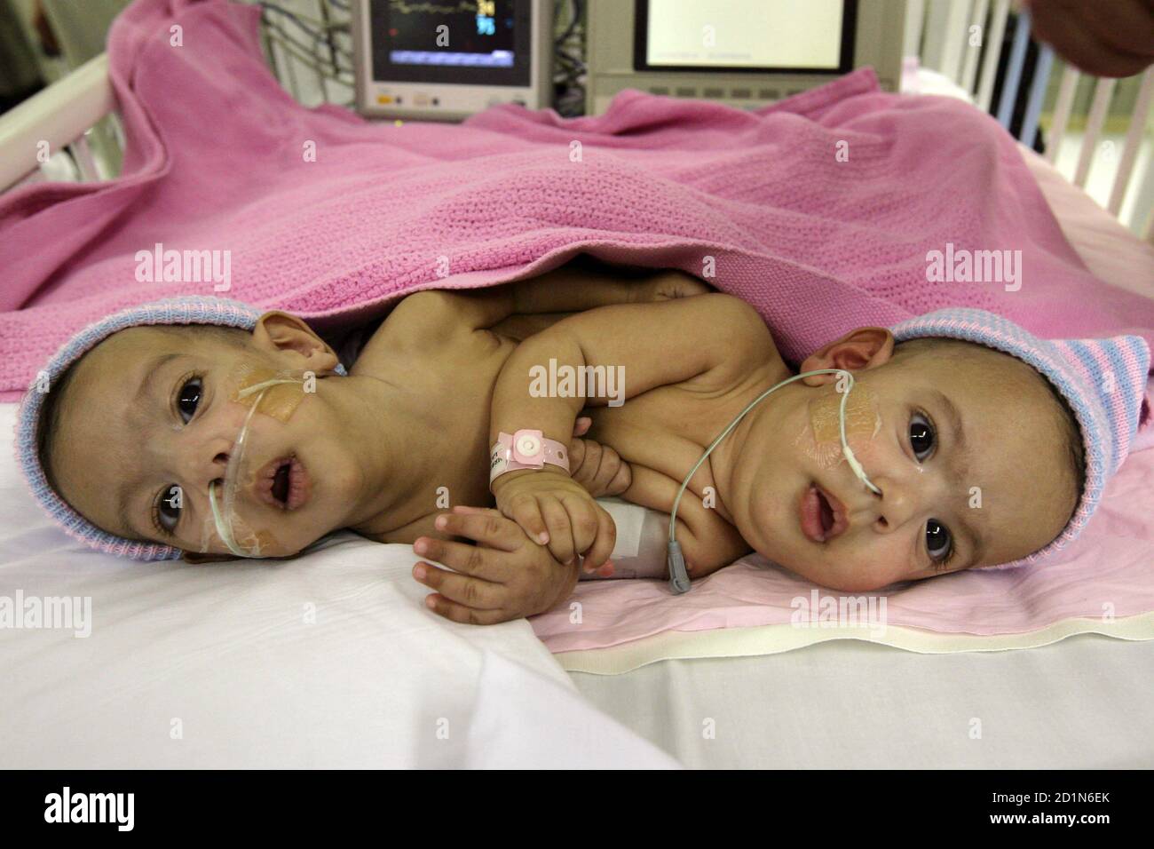 Conjoined Twins At The Pelvis