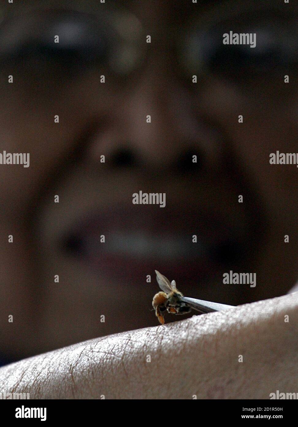 Bee stinging skin hi-res stock photography and images - Alamy