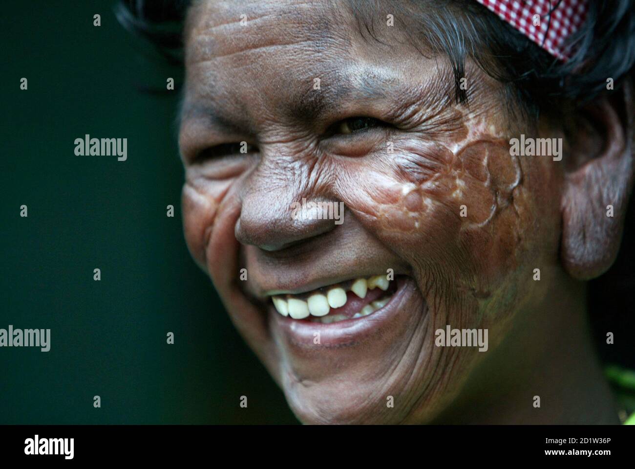 Leprosy Face High Resolution Stock Photography and Images - Alamy