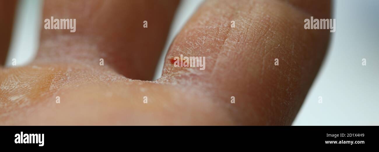 Sepsis skin hi-res stock photography and images - Alamy