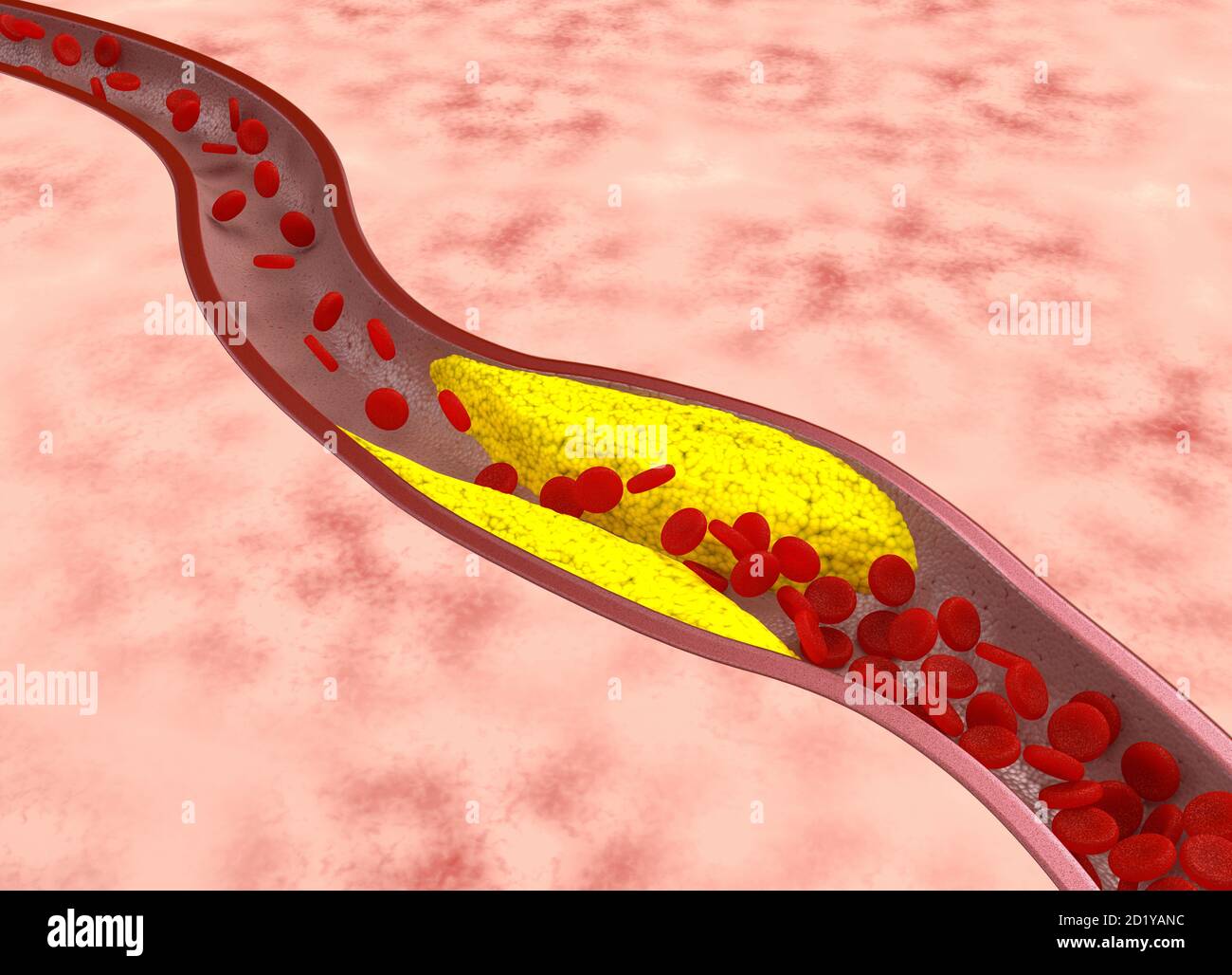 Artery Plaque High Resolution Stock Photography and Images - Alamy