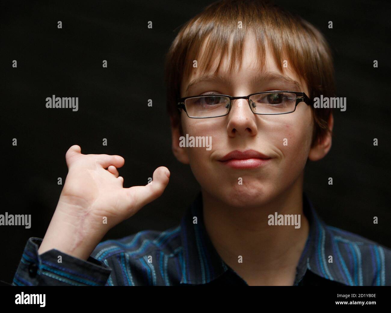 Hand birth defect hi-res stock photography and images - Alamy