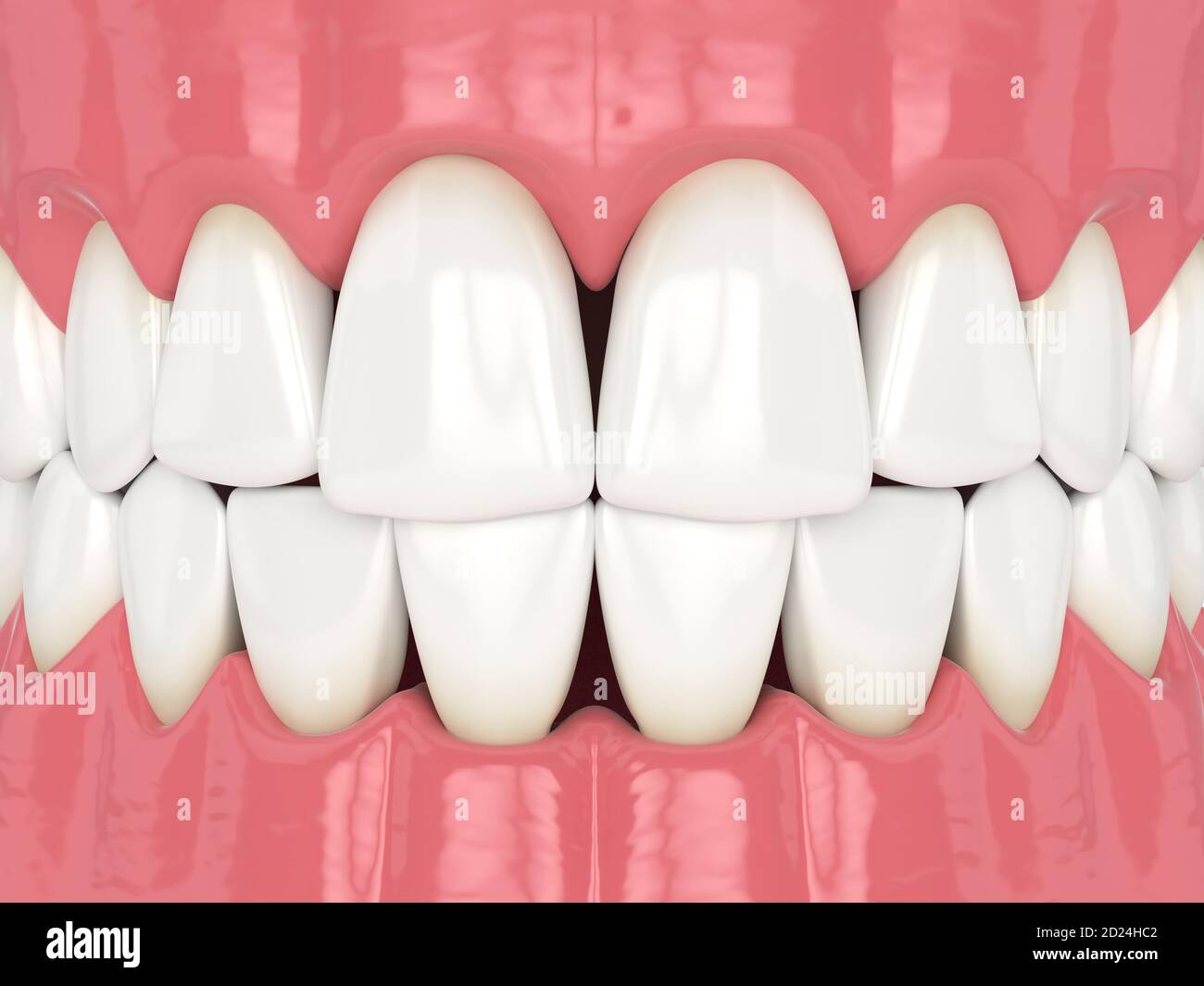 3d render of human jaw with black triangles between teeth Stock Photo ...