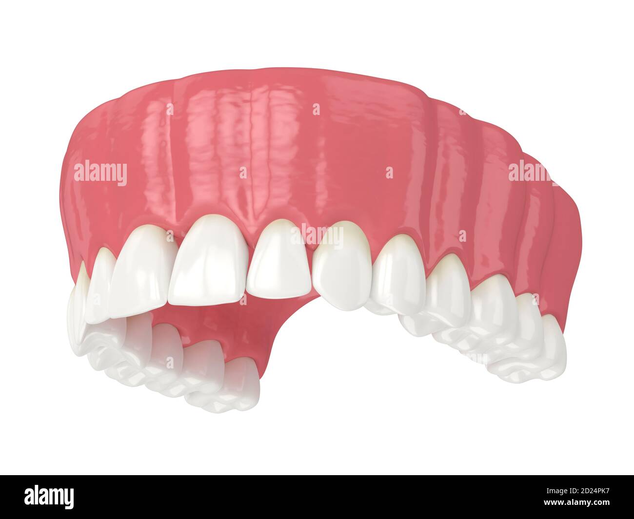 3d render of human upper jaw with black triangles between teeth Stock ...