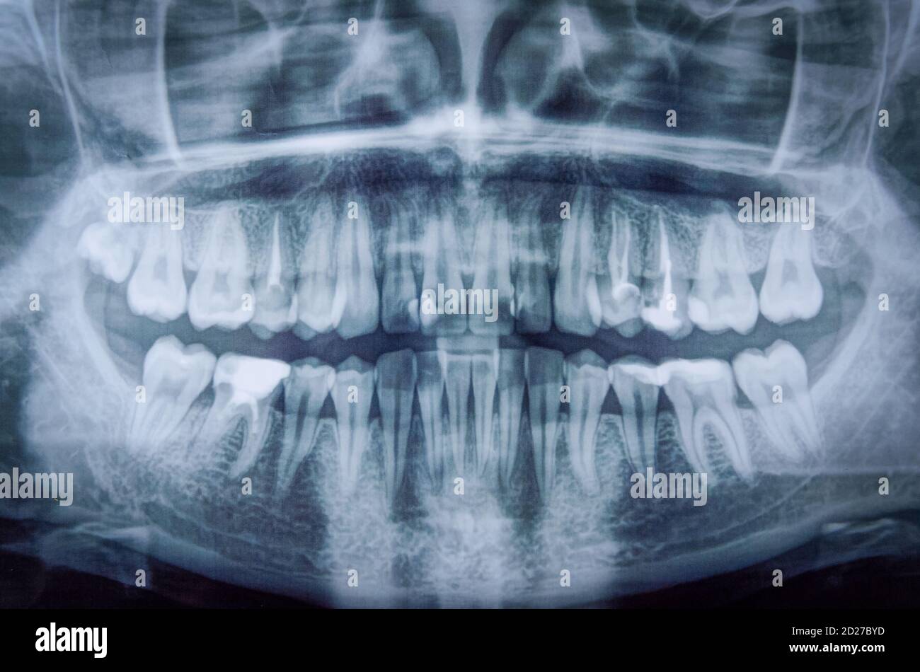 Radiography Skull Transparent Black White High Resolution Stock ...