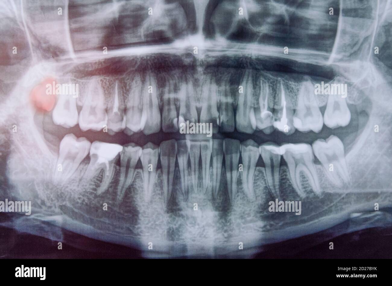 Panoramic x-ray scanning of human teeth. Female teeth with one wisdom ...