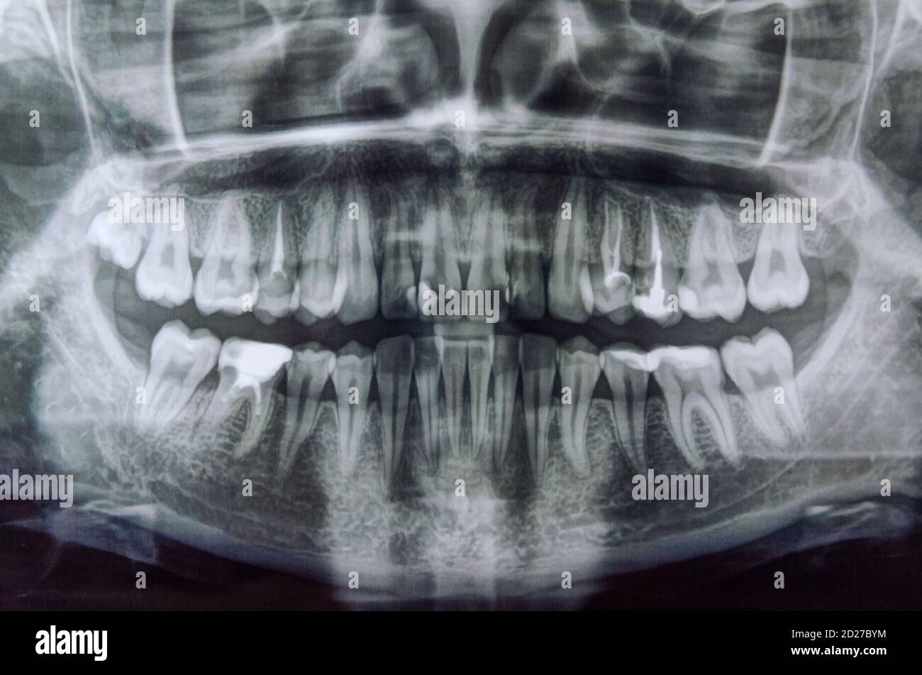 Panoramic x-ray scanning of human teeth. Women's the teeth with one ...