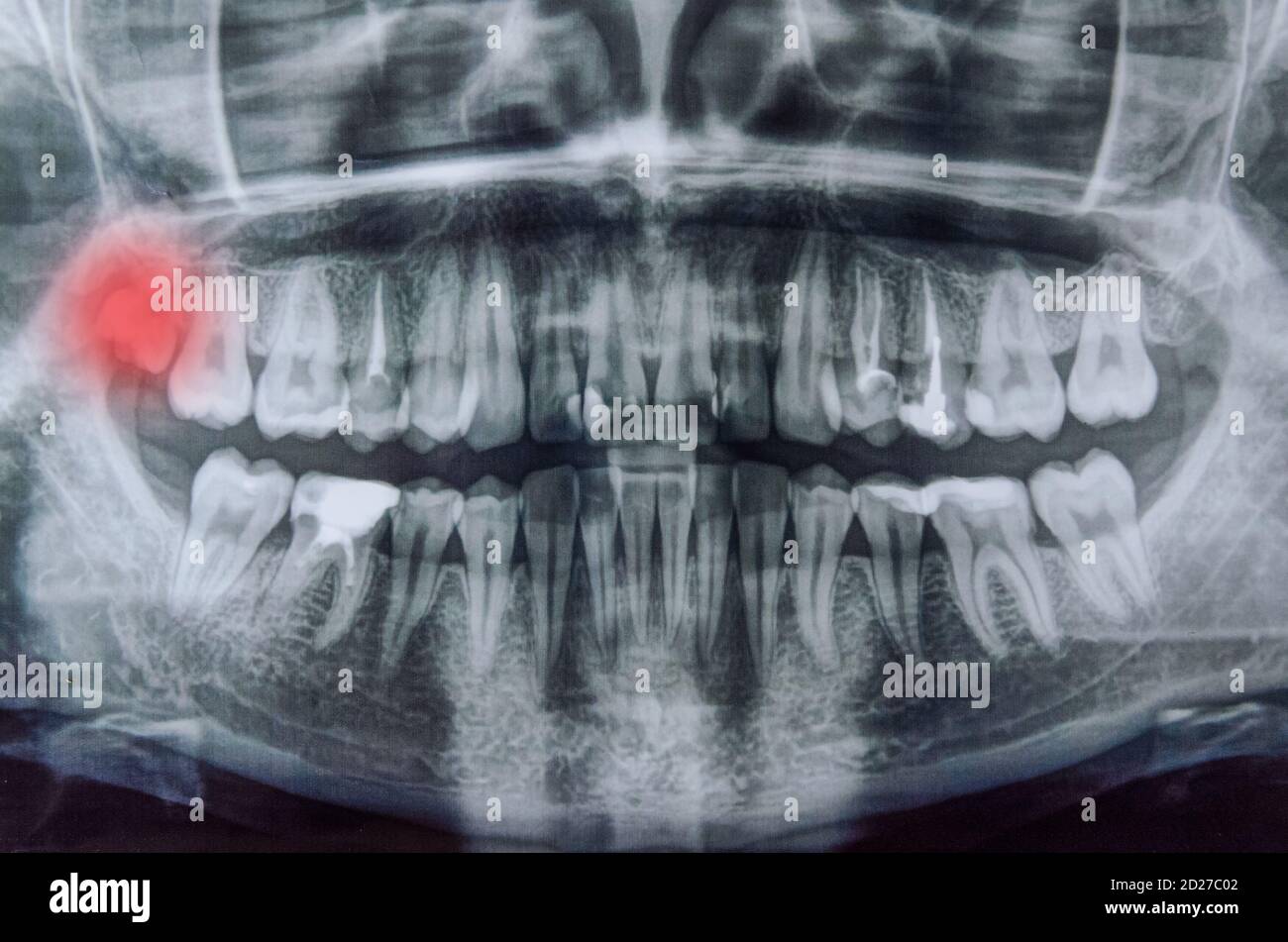 Panoramic x-ray scanning of human teeth. Female teeth with one wisdom ...
