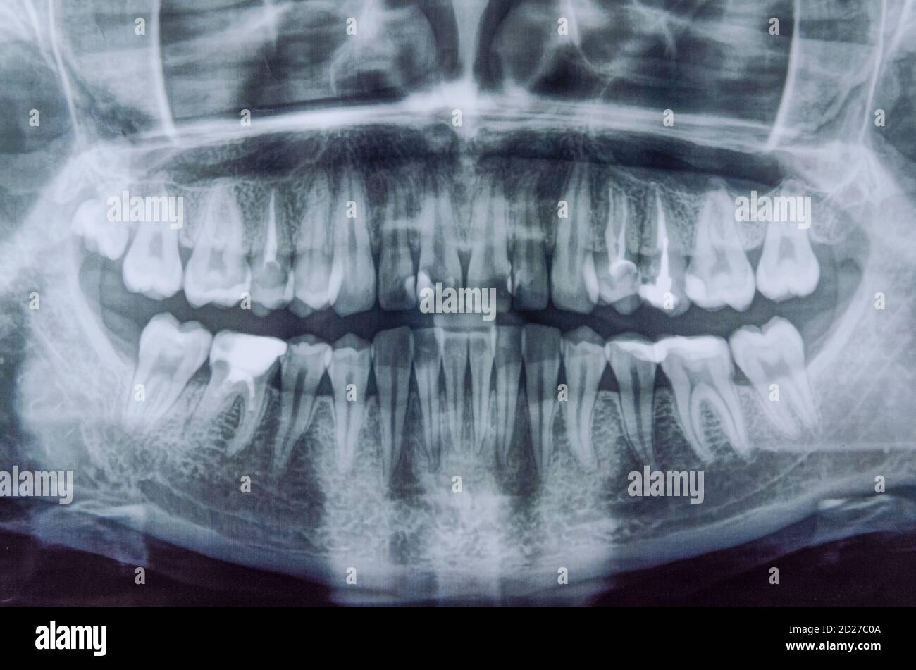 Panoramic x-ray scanning of human teeth. Women's the teeth with one ...