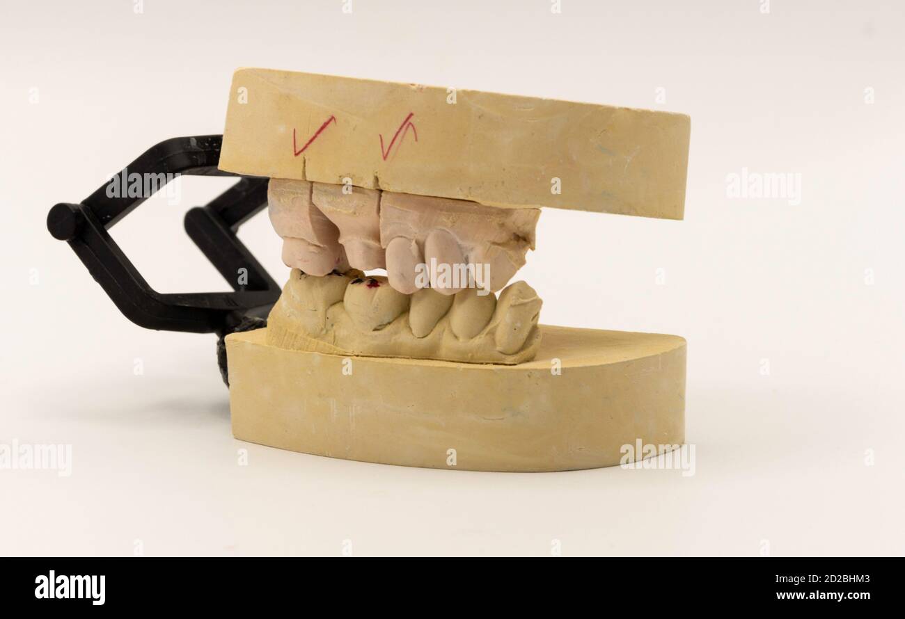 Dental Impression of Human Teeth Stock Photo - Alamy