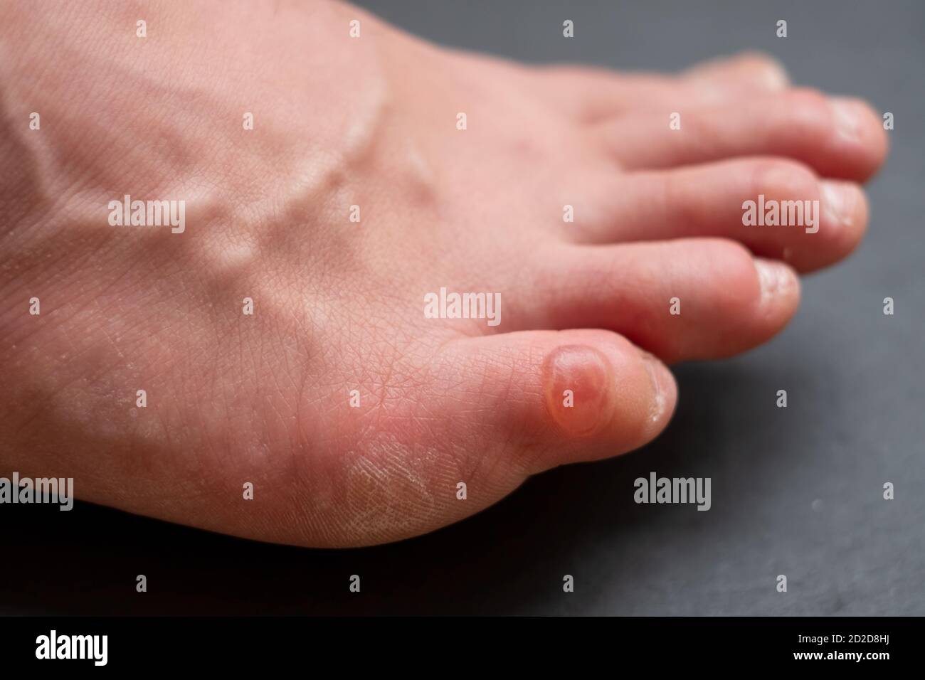 Callus on pinky toe after wearing uncomfortable shoes. Close up view ...