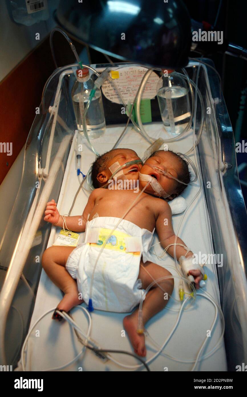 Conjoined twins baby hi-res stock photography and images - Alamy