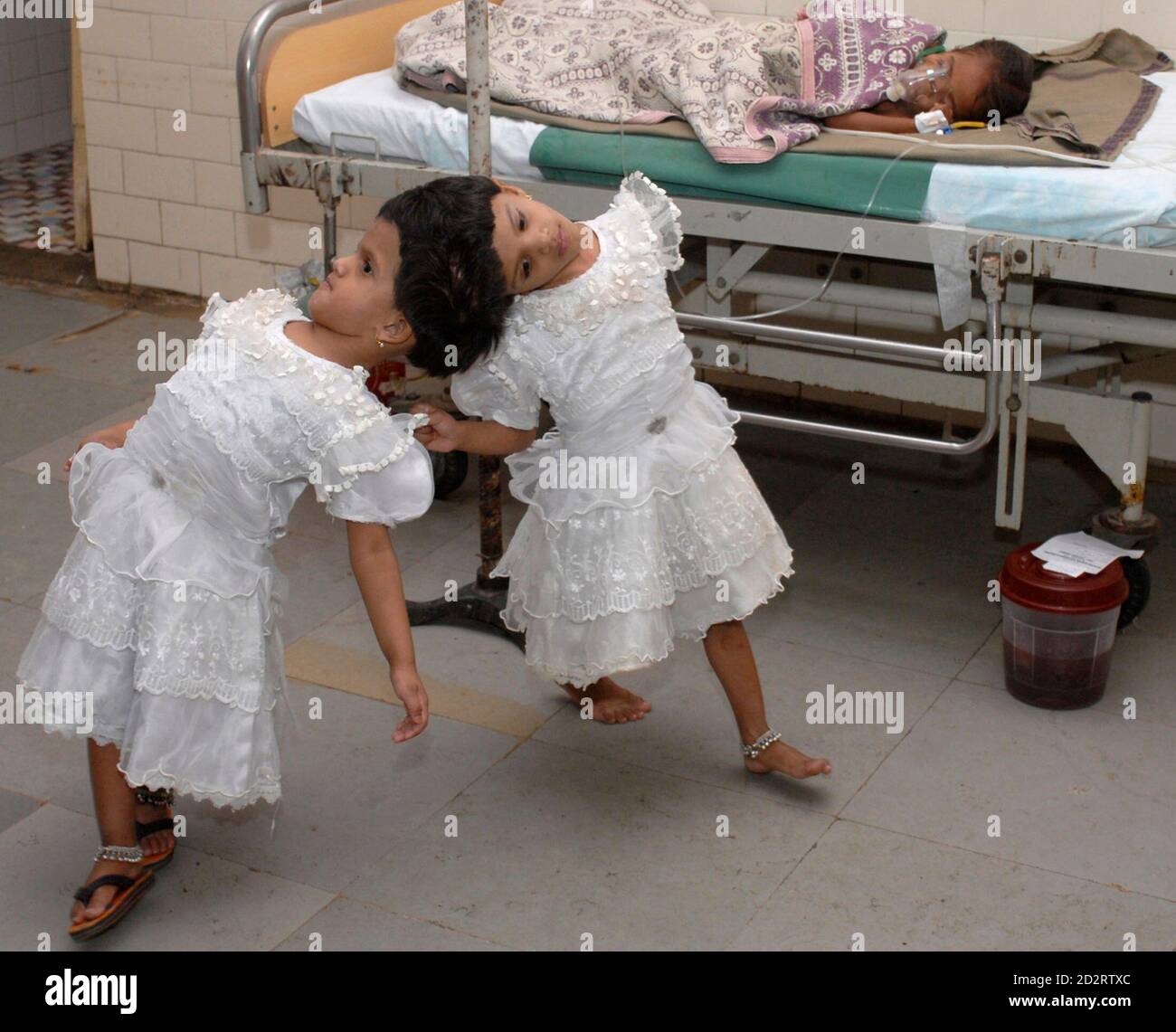 Human Conjoined Twins High Resolution Stock Photography and Images - Alamy