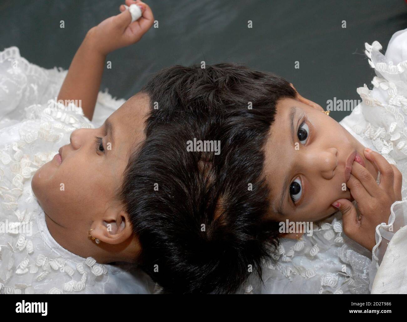 Human Conjoined Twins High Resolution Stock Photography and Images - Alamy