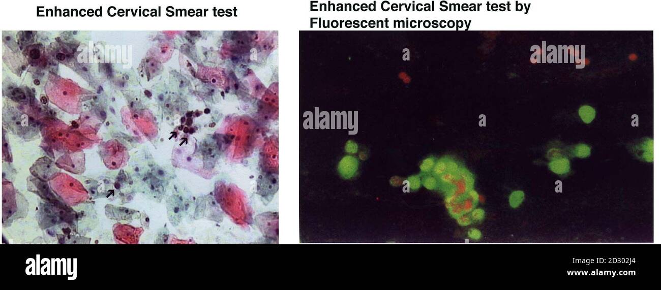 Normal cells in cervical smear hi-res stock photography and images - Alamy