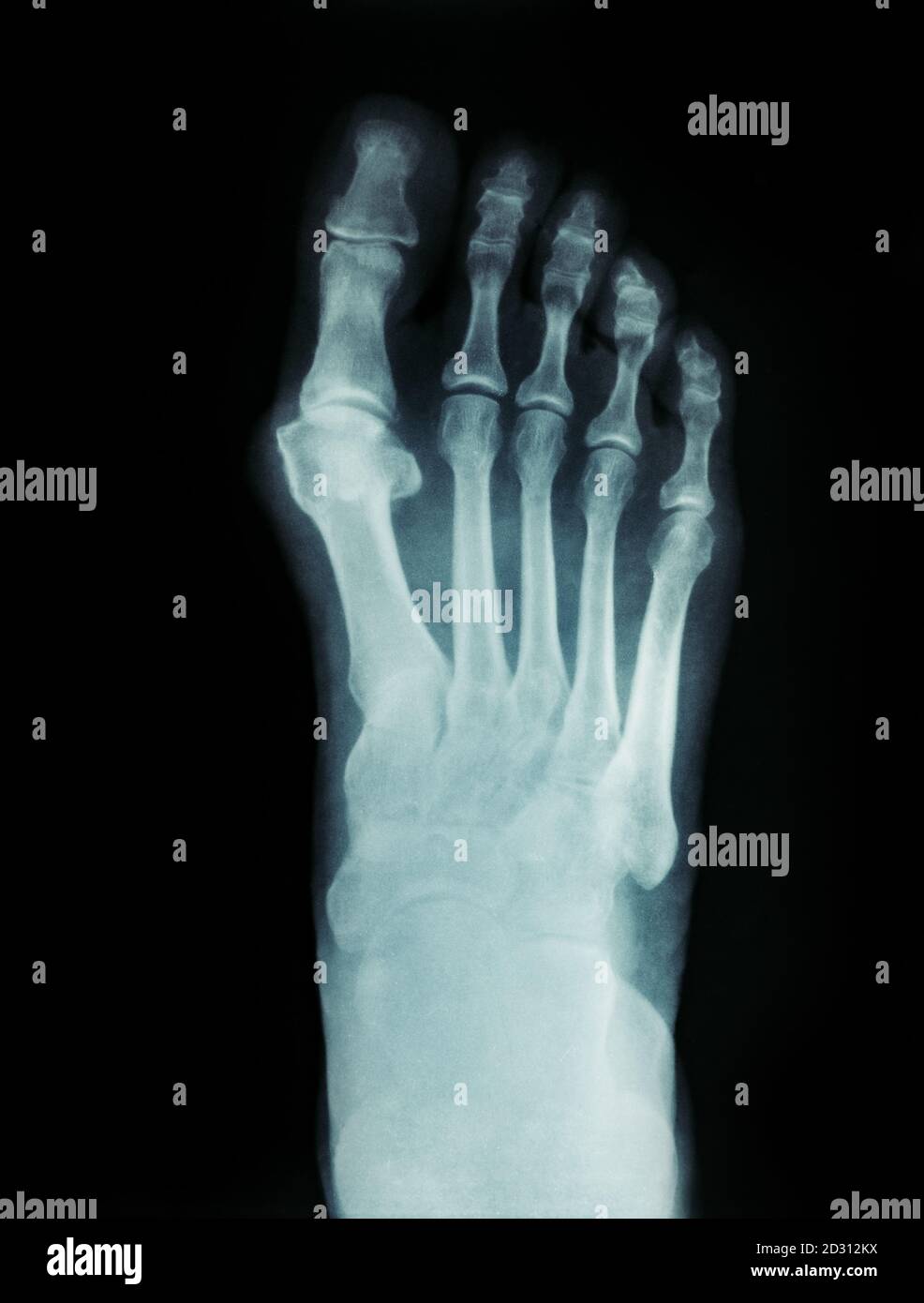 Hallux Rigidus X Ray