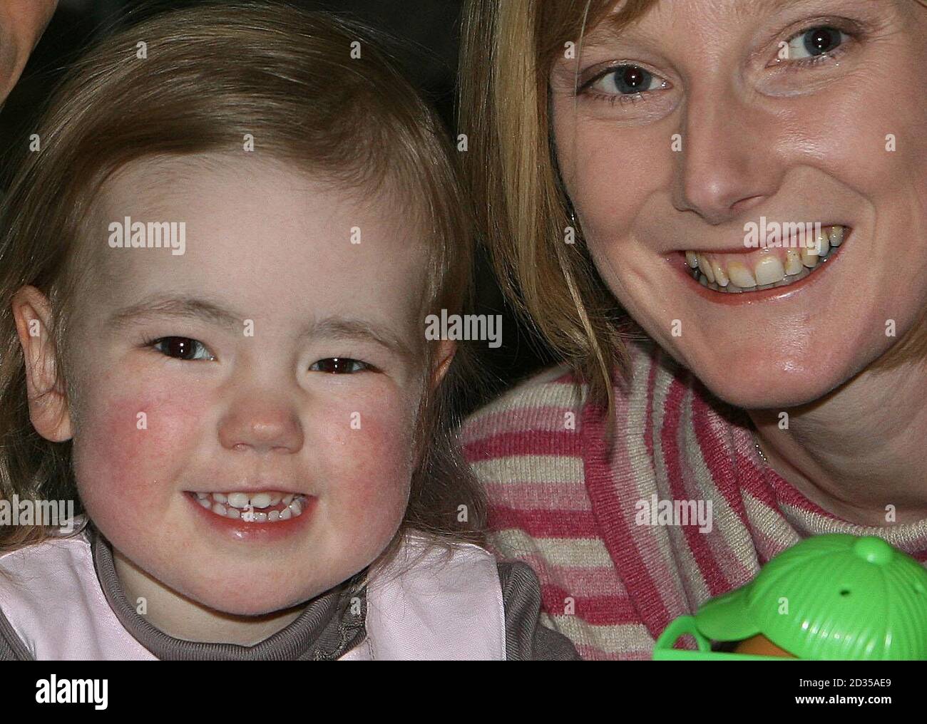 Abigail Hall, 3, from Lenzie, near Glasgow, Scotland, who underwent the ...