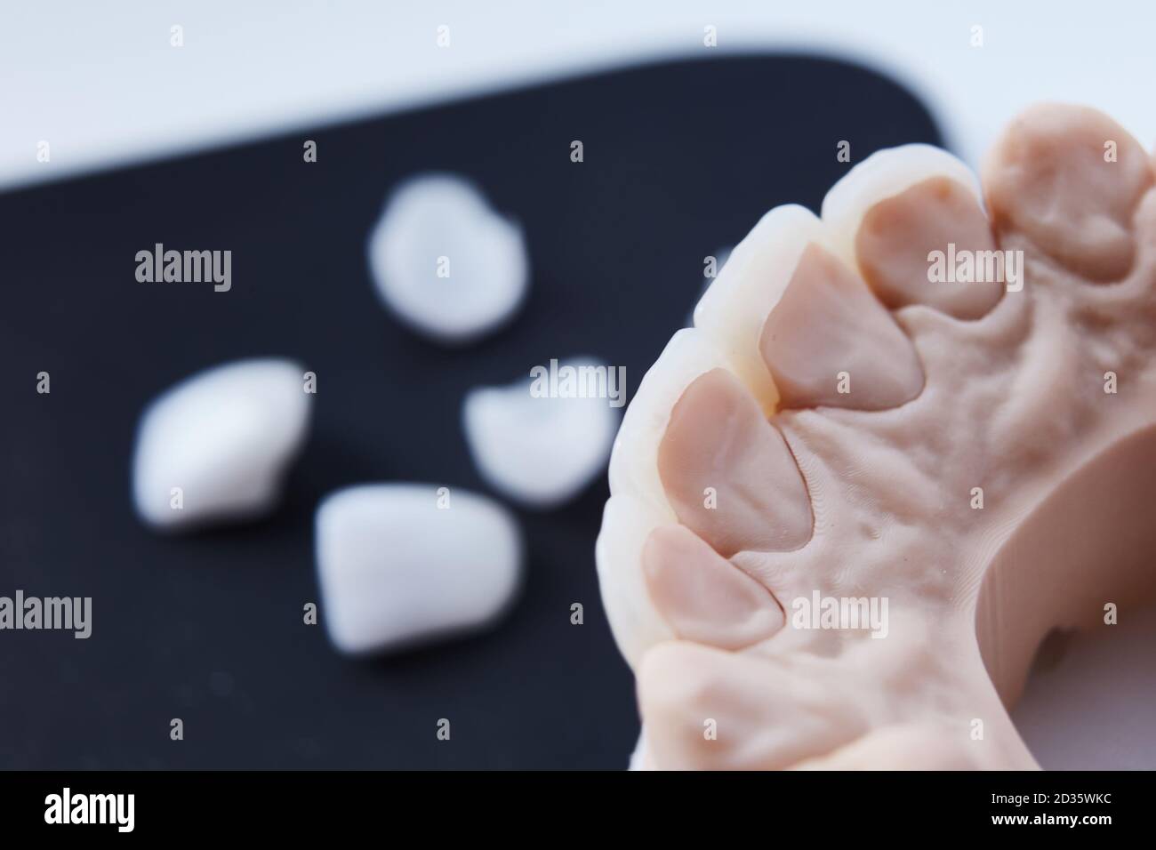 Ceramic dental veneers. Close-up view of dental layout of lower row of ...