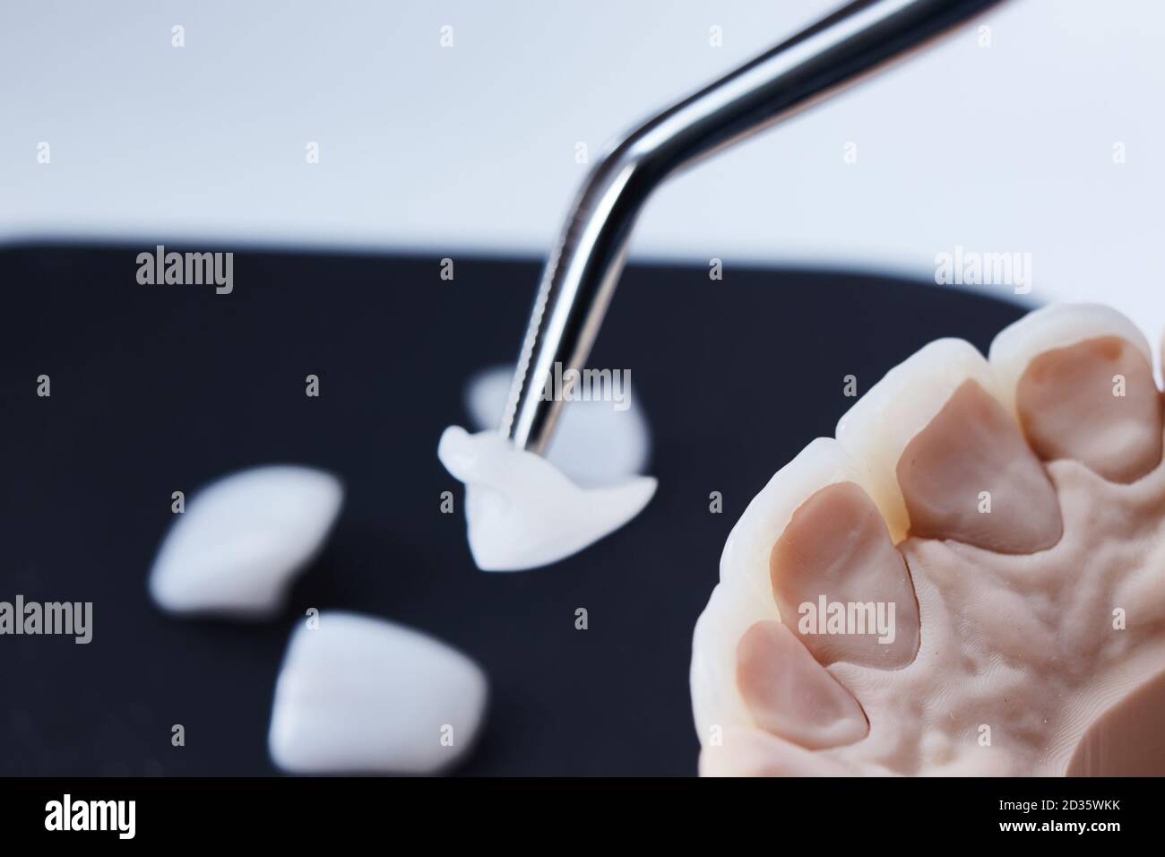 Ceramic dental veneers. Close-up view of dental layout of lower row of ...