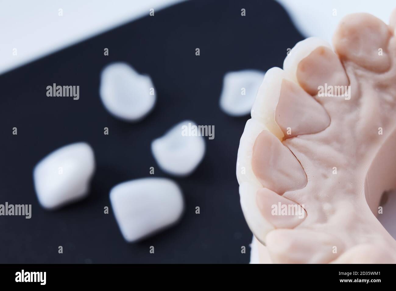 Ceramic dental veneers. Close-up view of dental layout of lower row of ...
