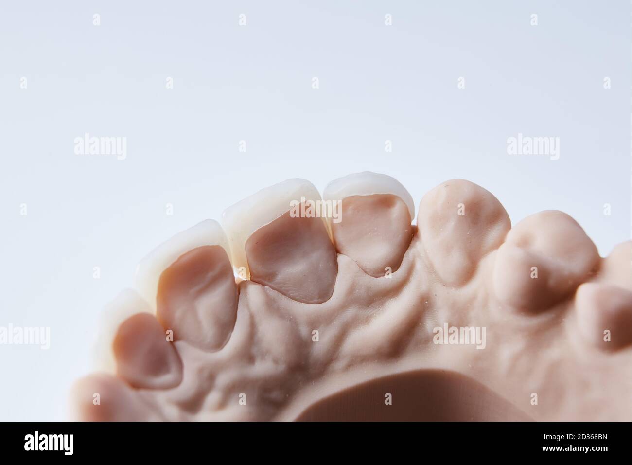 Ceramic dental veneers. Close-up view of dental layout of lower row of ...