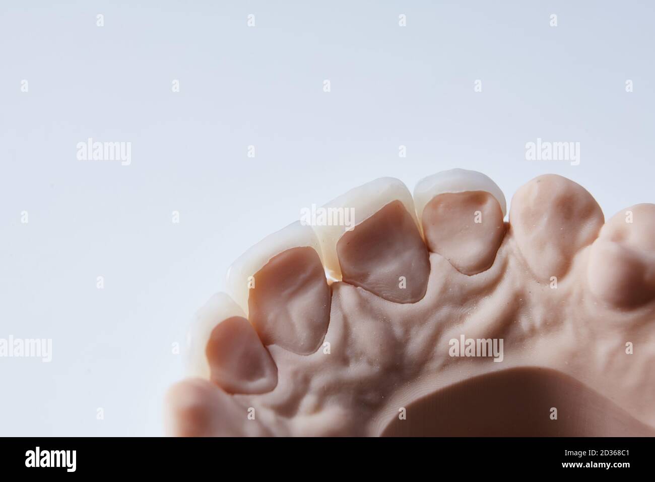 Ceramic dental veneers. Close-up view of dental layout of lower row of ...