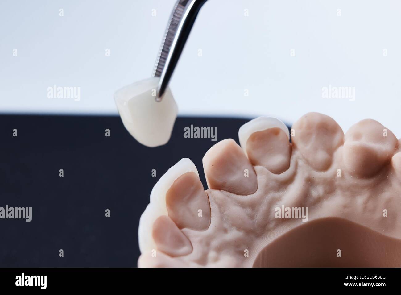 Ceramic dental veneers. Close-up view of dental layout of lower row of ...