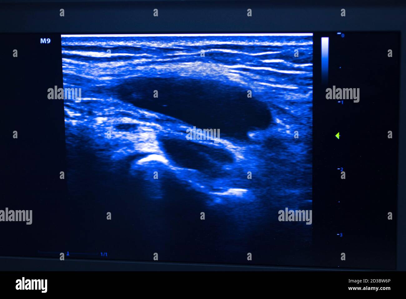EPI Intratissue Percutaneous Electrolysis dry needling ultrasound ...