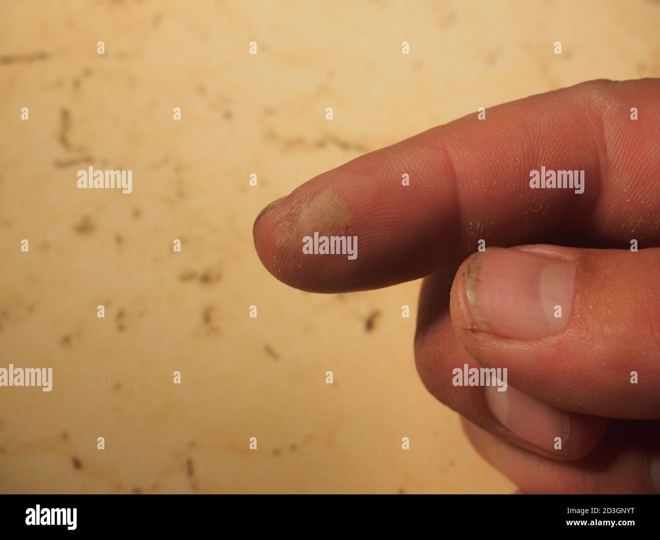 Thermal burn marks on a person's finger. Close up Stock Photo - Alamy