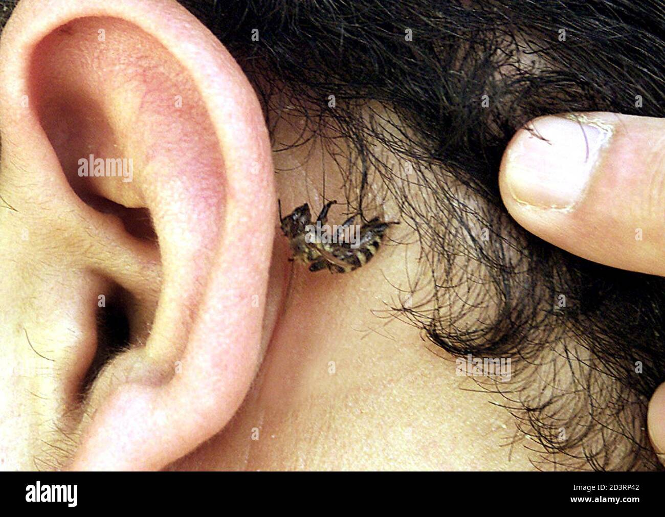Inflammation of the middle ear hi-res stock photography and images - Alamy