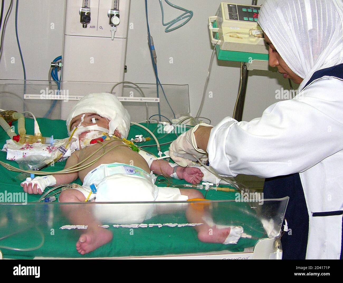 Craniopagus conjoined twins hi-res stock photography and images - Alamy