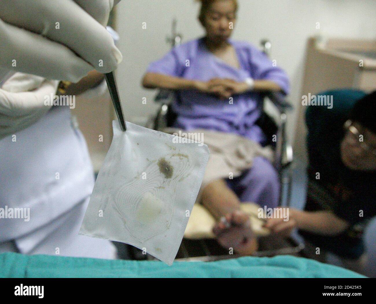 Maggot Debridement Therapy