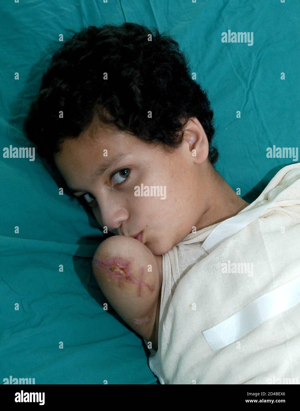 Double Arm Amputee High Resolution Stock Photography and Images - Alamy