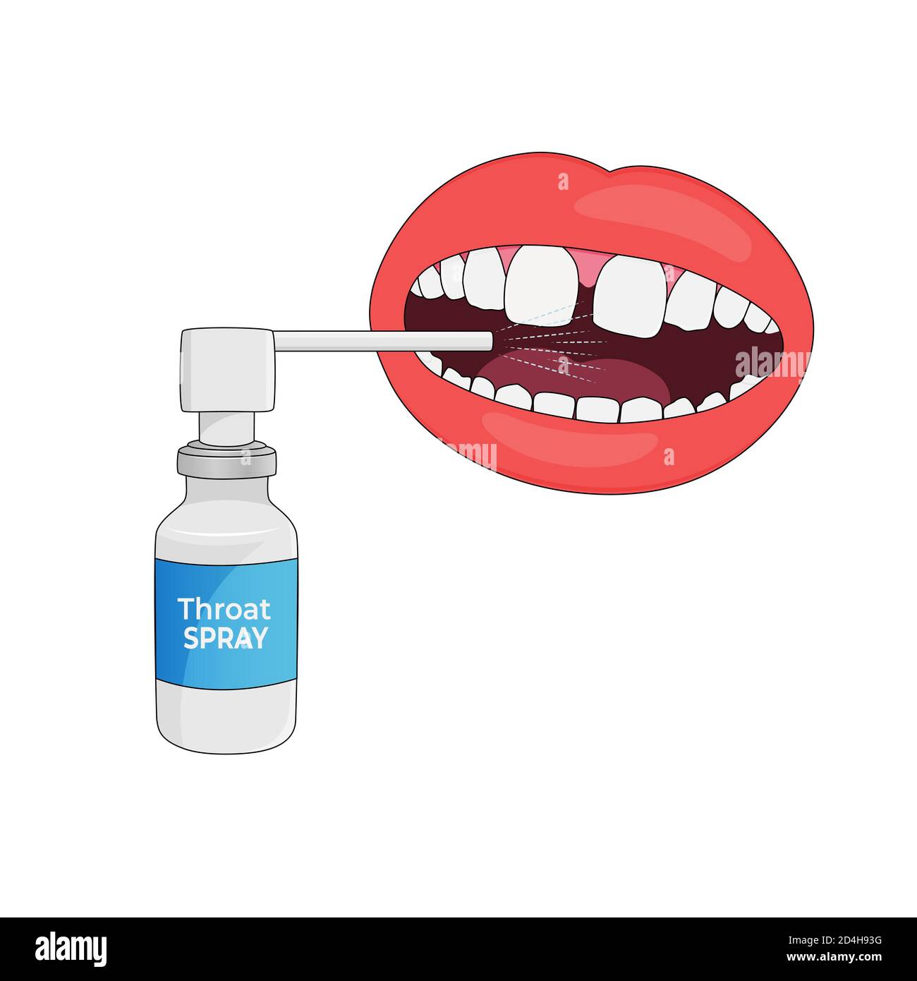 Oral, throat spray bottle spraying into the mouth, vector illustration ...