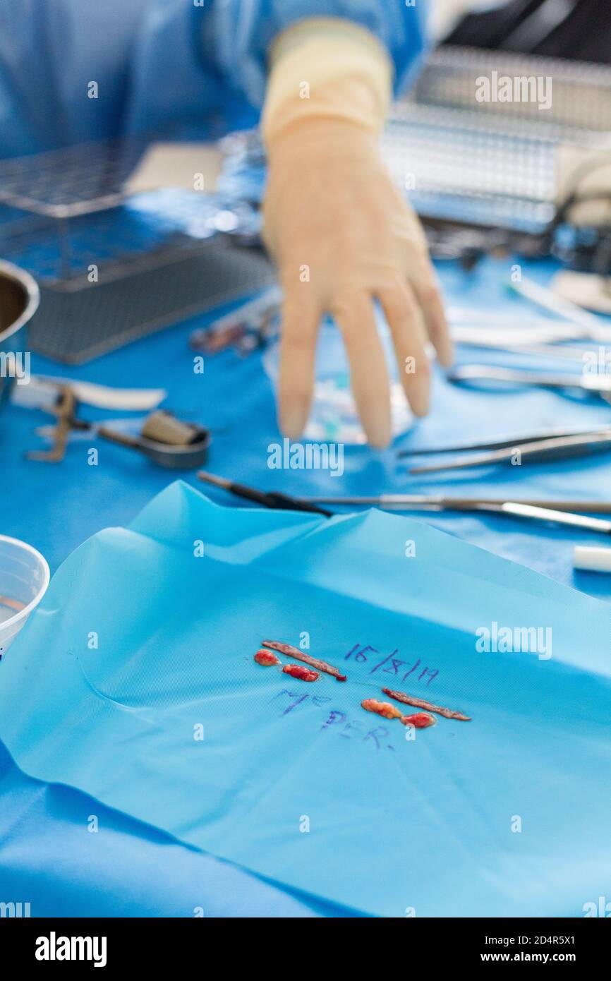 Blepharoplasty, surgery to remove the bags from under his eyes, France ...