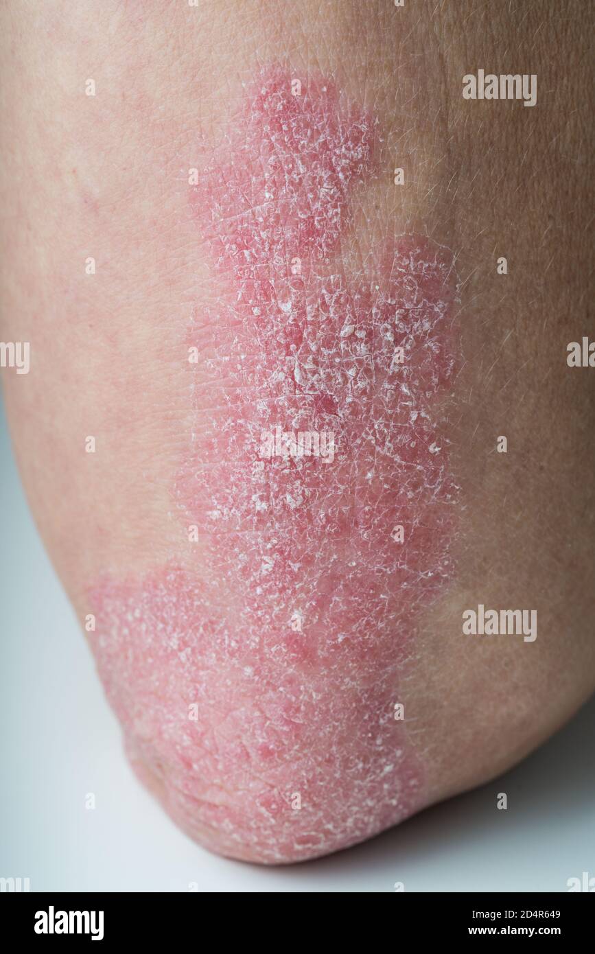 Dermatite hi-res stock photography and images - Alamy