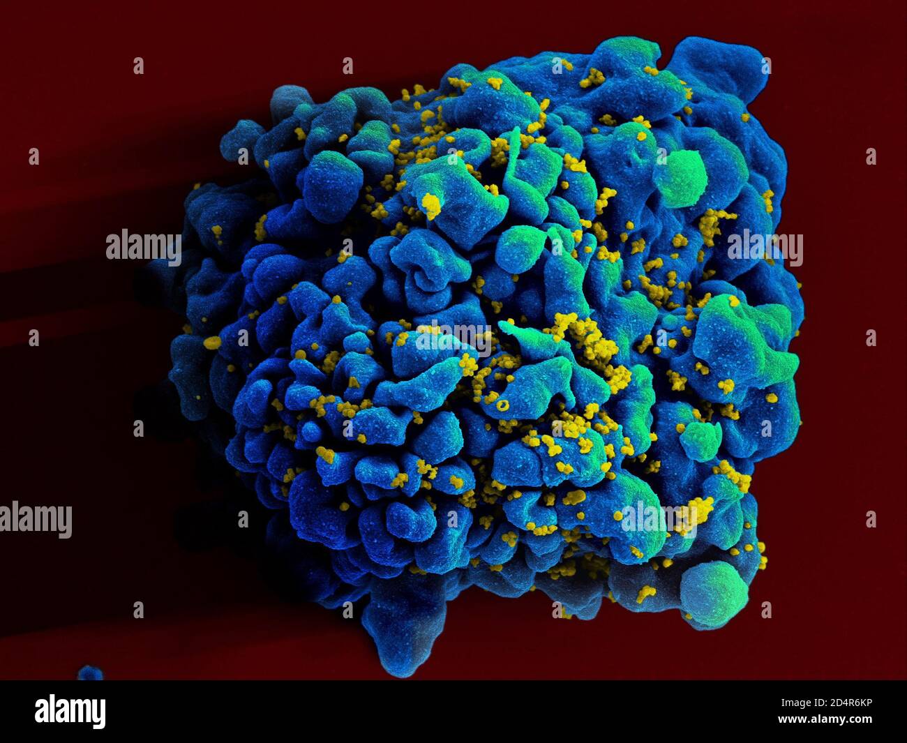 HIV-infected H9 T cell Scanning electromicrograph of an HIV-infected H9 ...