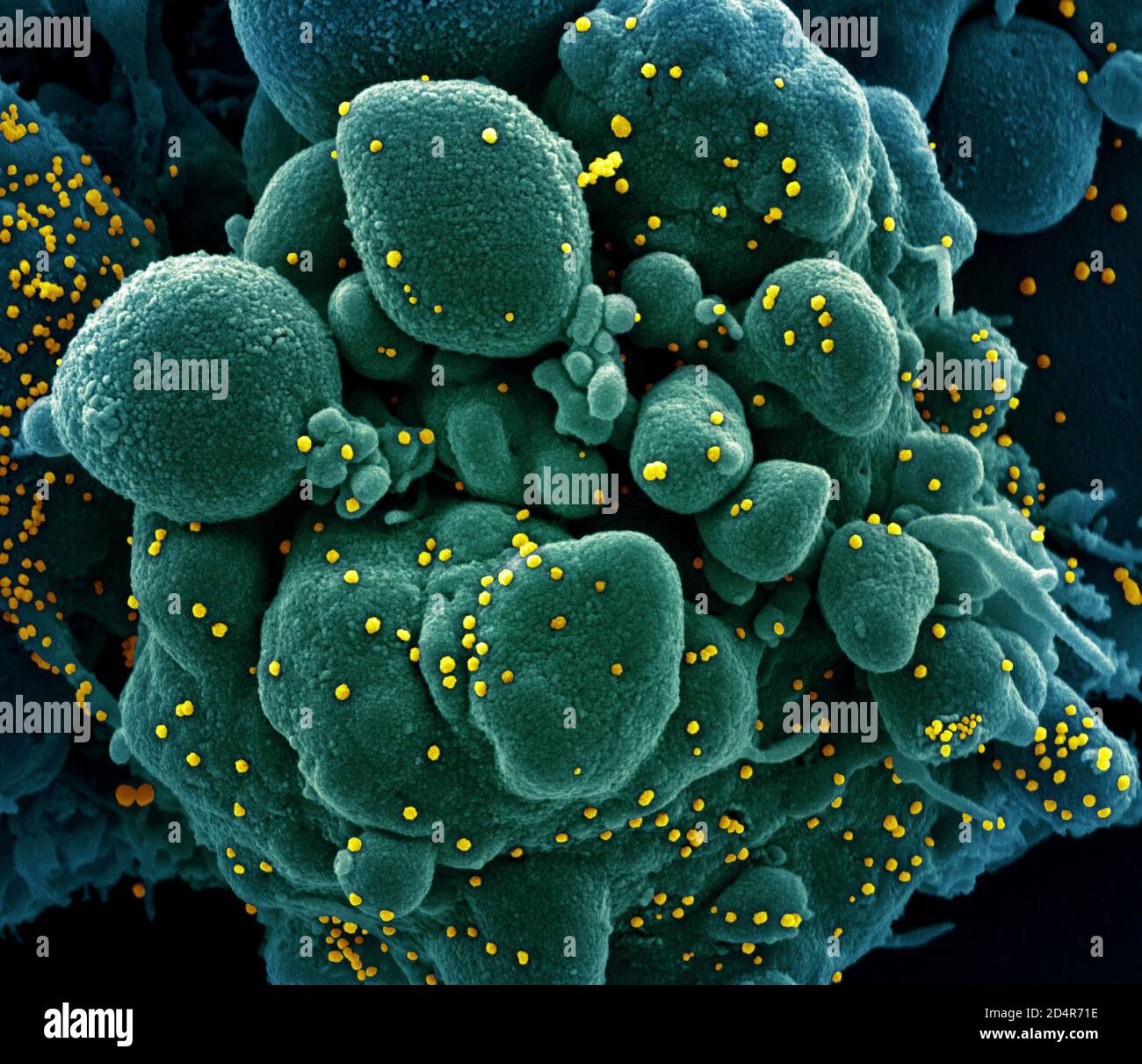 Novel Coronavirus SARS-CoV-2. SARS-CoV-2Colorized scanning electron ...