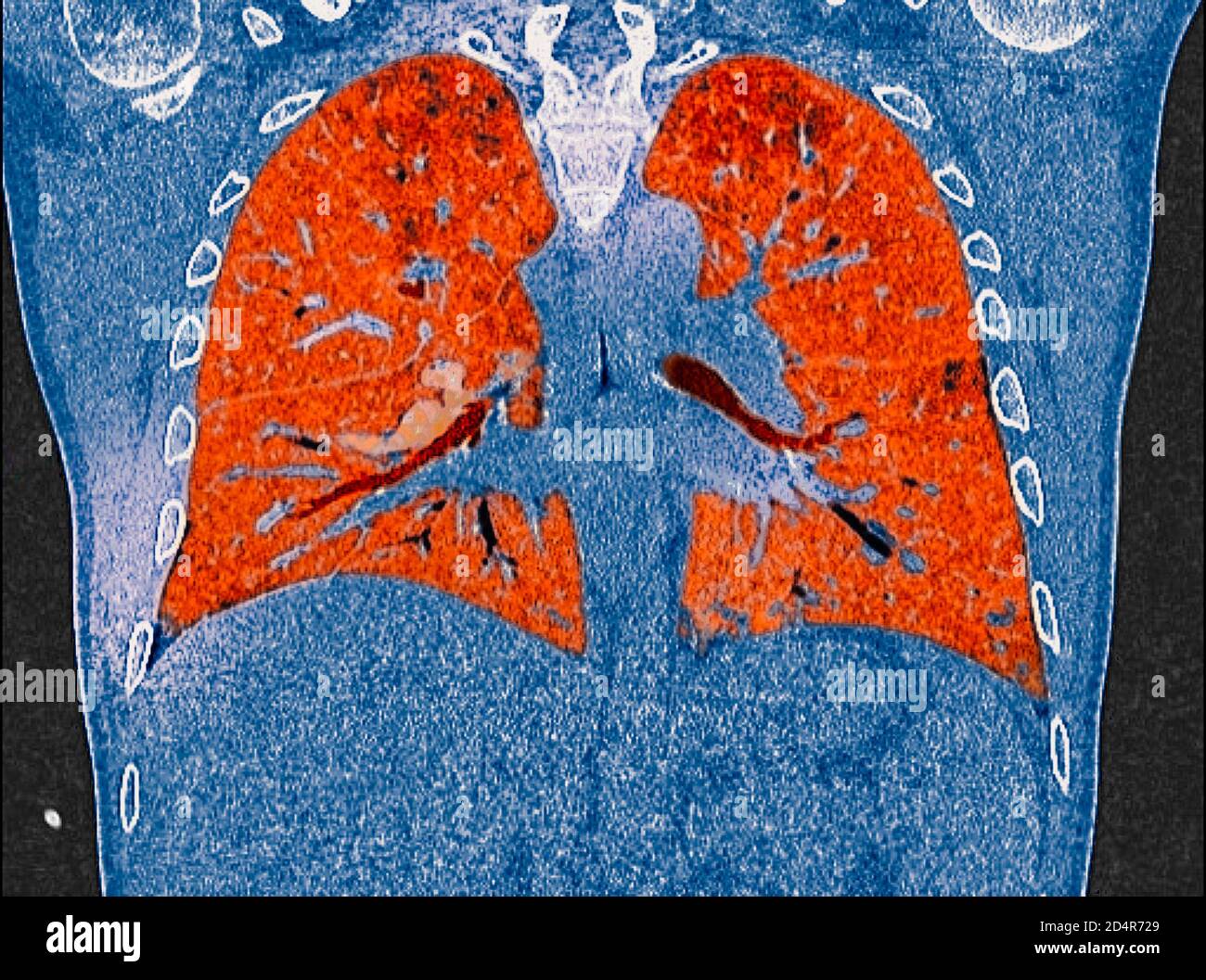 Lungs affected by Covid-19 coronavirus, tomography (CT) scan Stock ...